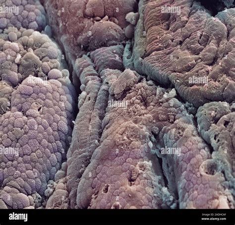Colon Cancer Coloured Scanning Electron Micrograph Sem Of The Mucosa Lining Of The Colon