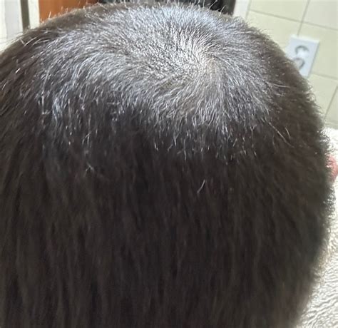 항암후 머리카락 지식in