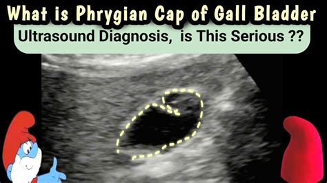 What Is Phrygian Cap Of Gall Bladder Ultrasound Diagnosis Is This