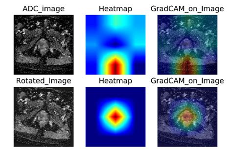 Gradcam Visualizations Of A Misclassified Positive Example And Its