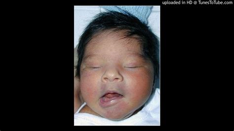 Neonatal Facial Nerve Palsy