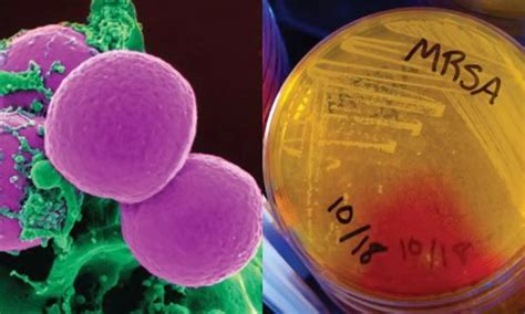 Oral Minocycline Plus Rifampicin As Good As Oral Linezolid For Treating