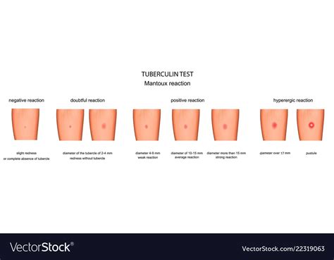 Evaluation Of Mantoux Test Response Royalty Free Vector