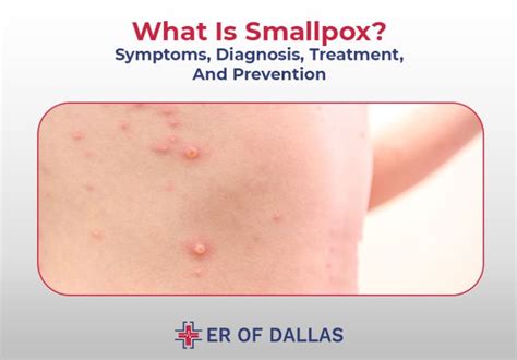 What Is Smallpox Symptoms Diagnosis Treatment And Prevention Er