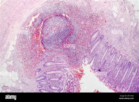 Histopathology Of Chronic Appendicitis Light Micrograph Photo Under