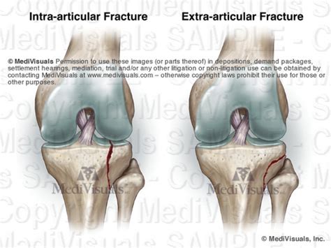 Intraarticular Fracture