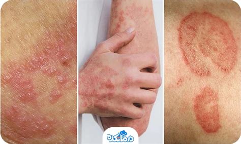 قارچ پوستی چیست؟ انواع، علت بهترین درمان‌های خانگی و پزشکی