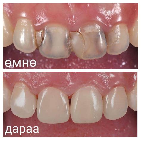 Хоёрдогч цоорол гэж юу вэ Цэгц Дент шүдний эмнэлэг
