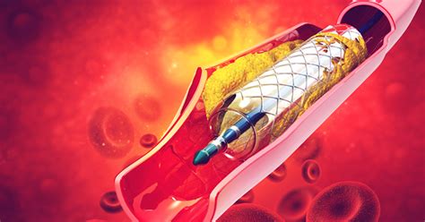 5 Year Data Show Titanium Nitride Oxide Coated Stents May Be Safer Than Des