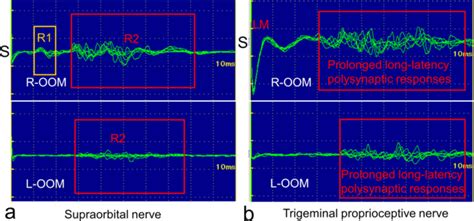 Trigeminal Proprioception Evoked By Strong Stretching Of The
