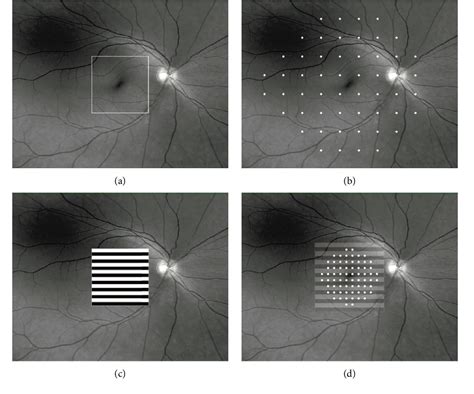 Table 1 From Correlations Between Steady State Pattern Electroretinogram And Humphrey Visual