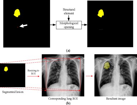 Figure 9 From Deep Learning Based Classification And Semantic Segmentation Of Lung Tuberculosis