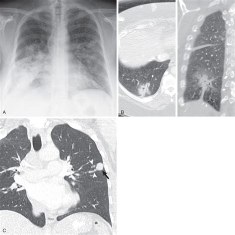 Chest X Ray Fungal Pneumonia At Doris Whitfield Blog