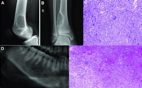 Plain Radiographs Of Non Ossifying Fibroma In The Distal Femur Of A Download Scientific Diagram