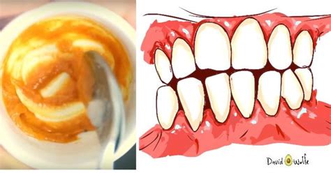 This Homemade Toothpaste Reverses Gum Disease And Whitens Teeth David Avocado Wolfe