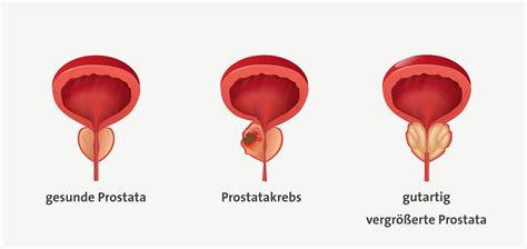Prostatakrebs Cellede Celle Prostatakrebs Forum Zowcyk