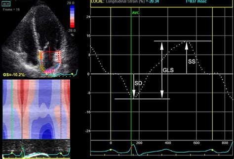A Normal Left Atrial Strain Curve In A Complete Cardiac Cycle La