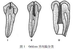 病例分享上颌侧切牙III型牙内陷根管治疗一例
