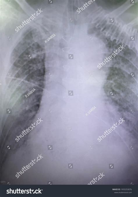 Film Xray Show Diffuse Reticular Infiltration库存照片1955253076 Shutterstock
