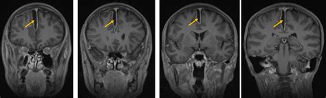 Subdural Empyema Radiology Cases