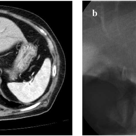 Abbreviation Ptcd Percutaneous Trans Hepatic Cholangiodrainage This Download Scientific