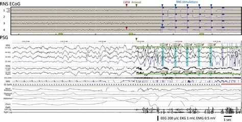 Epileptiform Activity Can Precede Arousal And Rns System Stimulation