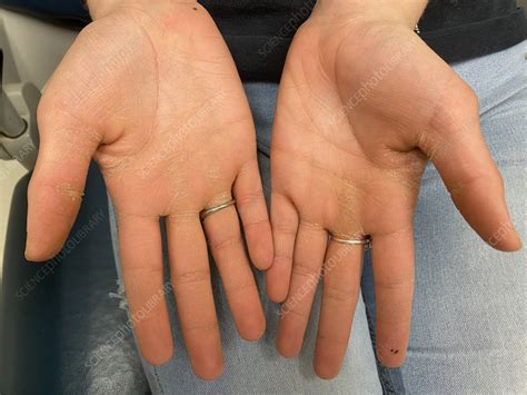 Palmoplantar Keratoderma Stock Image C057 2073 Science Photo Library