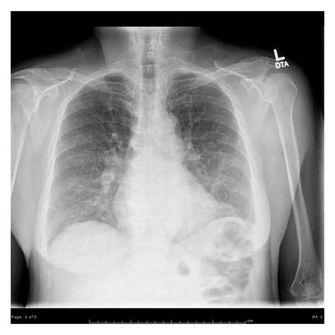 Lung Imaging On Admission A Chest Radiograph Showing Prominent