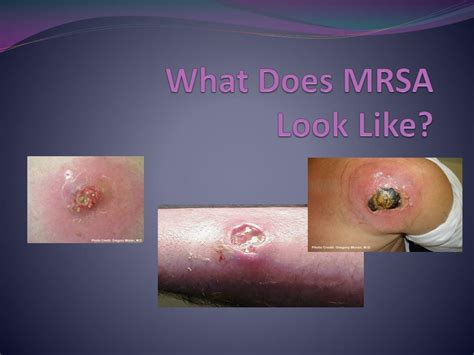Mrsa Infection