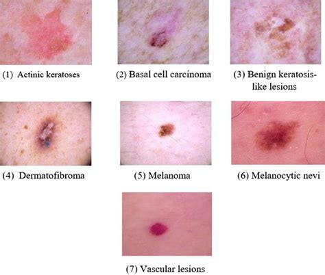 Skin Lesion Classification Of Dermoscopic Images Using Machine Learning And Convolutional Neural