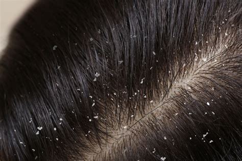 8 Common Scalp Problems Photos Causes Treatments