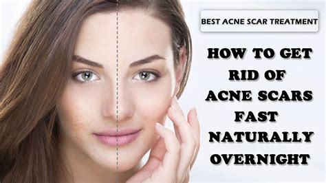 How To Get Rid Of Scars Naturally My Favorite Things