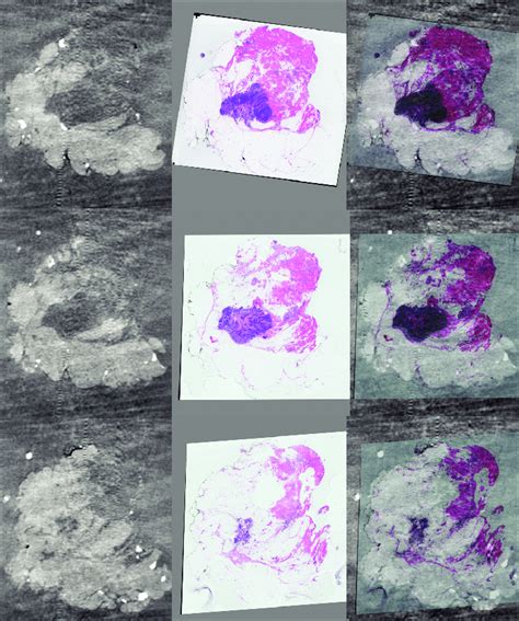 Correlation Between Imaging Histology And 3 Dimensional 3 D