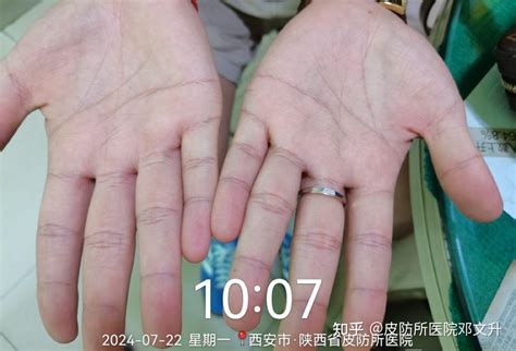 梅毒的治疗既简亦难！ 知乎