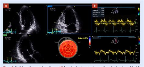 Figure 3 From Left Atrium Remodeling After Catheter Ablation Of Atrial Fibrillation Semantic