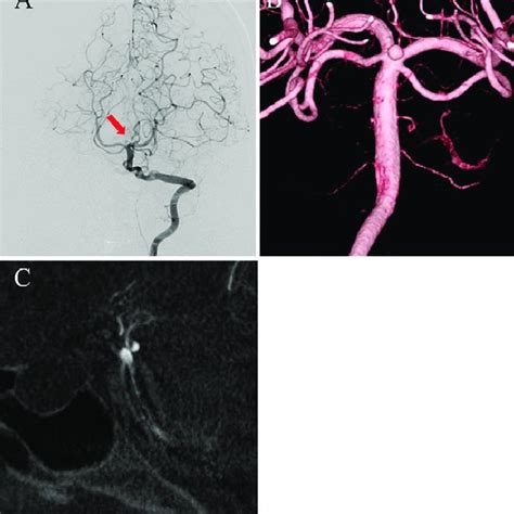 Second Dsa On Day 17 A Left Vertebral Angiography Shows A Download Scientific Diagram