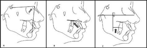 Representation Of The A Snb Angle B 6mxena Enp Angle C