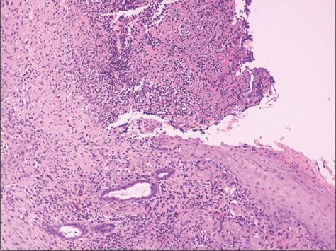 Pyoderma Gangrenosum Histology