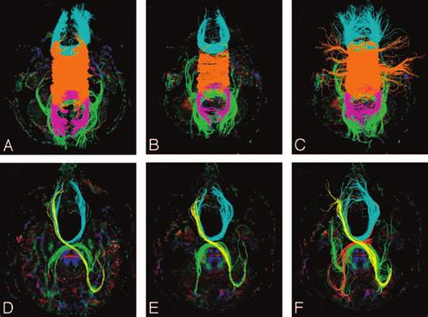Comparison Of Dti And Qbi Tractography For A Control Subject Top And Download Scientific