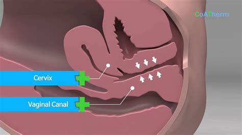 What Are The Benefits And Drawbacks Of Non Surgical Genital Renewal