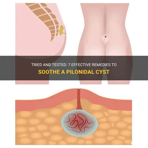 Tried And Tested 7 Effective Remedies To Soothe A Pilonidal Cyst Medshun