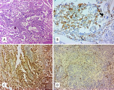 a a case of occc with mmr d status b pd l1 expression in 11 25 of