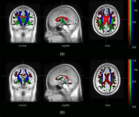 Fractional Anisotropy Fa Maps For Averaged Data Sets A Healthy