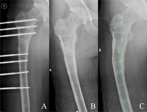 A 47 Year Old Male Patient With Right Femoral Bone Defect Caused By