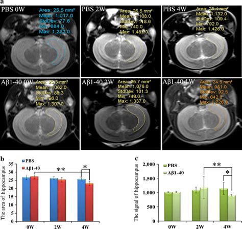 Imaging Of The Hippocampus Using T2wi A Population Based T2 Weighted Download Scientific
