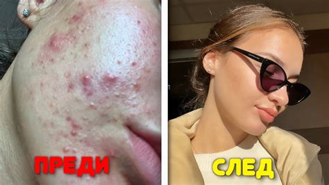 МОЯТА БОРБА С АКНЕТО ГРИЖА И ПРОЦЕДУРИ Youtube