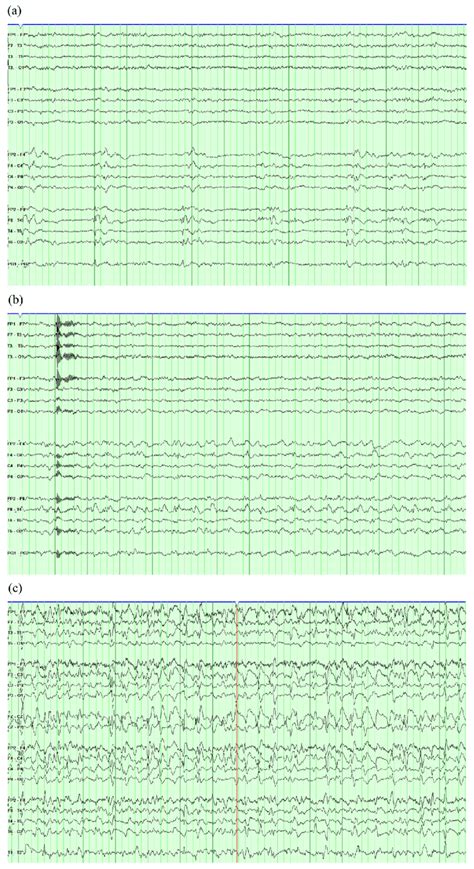 eeg examples of patterns on the ictal interictal continuum from the