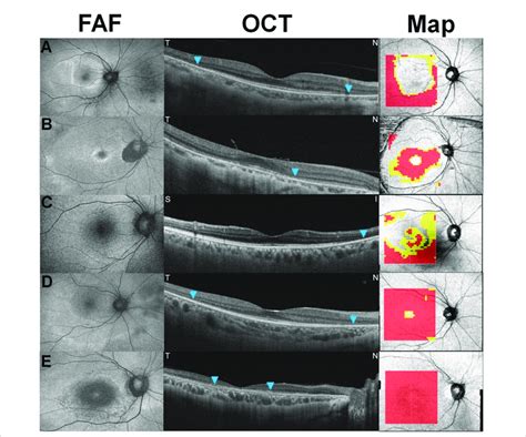 Five Recognizable Patterns [a Pericentral Ring A Parafoveal Ring Download Scientific Diagram
