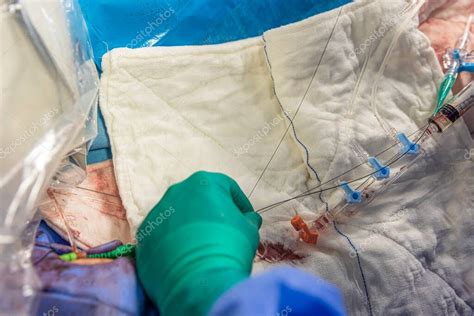 Proceso De Colocación De Stent Cardíaco En Quirófano Médico Del