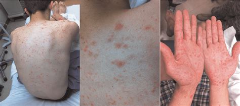 Epstein Barr Virus Rash Infectious Mononucleosis Wikipedia Magomed Musliyevich